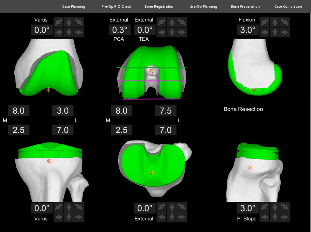 Mako TKA Planning - sportsmed