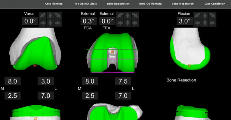 Mako SmartRobotics™ for hip and knee surgery - sportsmed